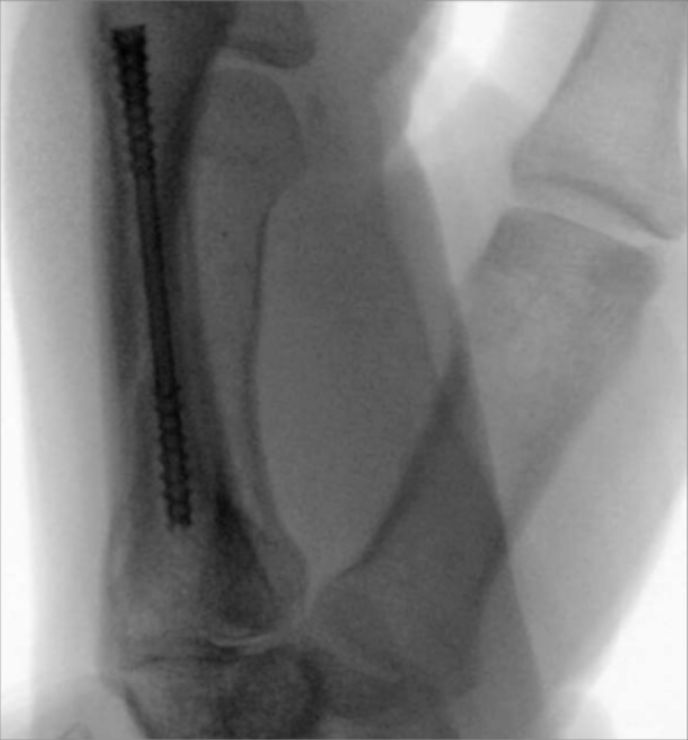 NX Nail for fixation of spiral fracture of fourth metacarpal.